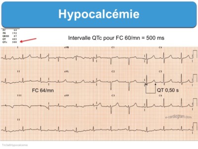 Hypocalcémie : e-cardiogram