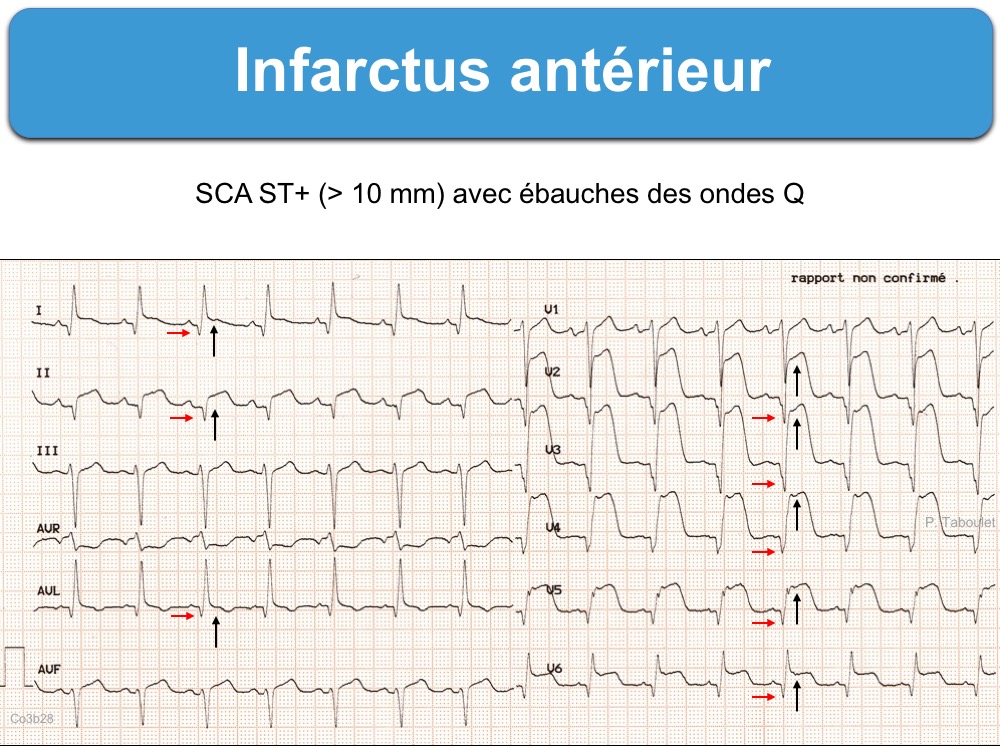 Infarctus 4. Antérieur : e-cardiogram