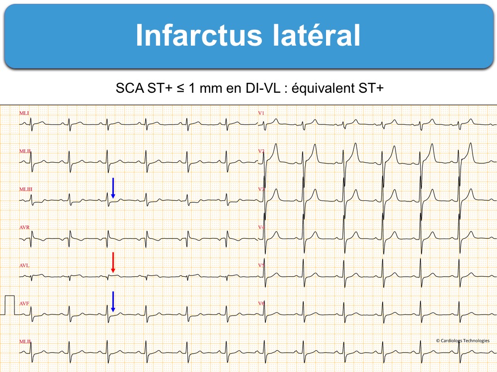 Infarctus 4. Latéral : e-cardiogram
