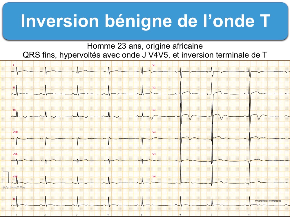 Inversion bénigne de l’onde T : e-cardiogram