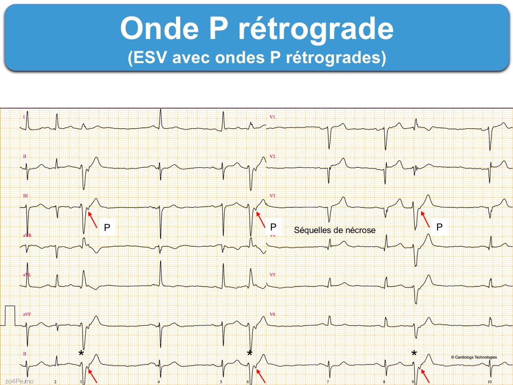 Onde P rétrograde : e-cardiogram