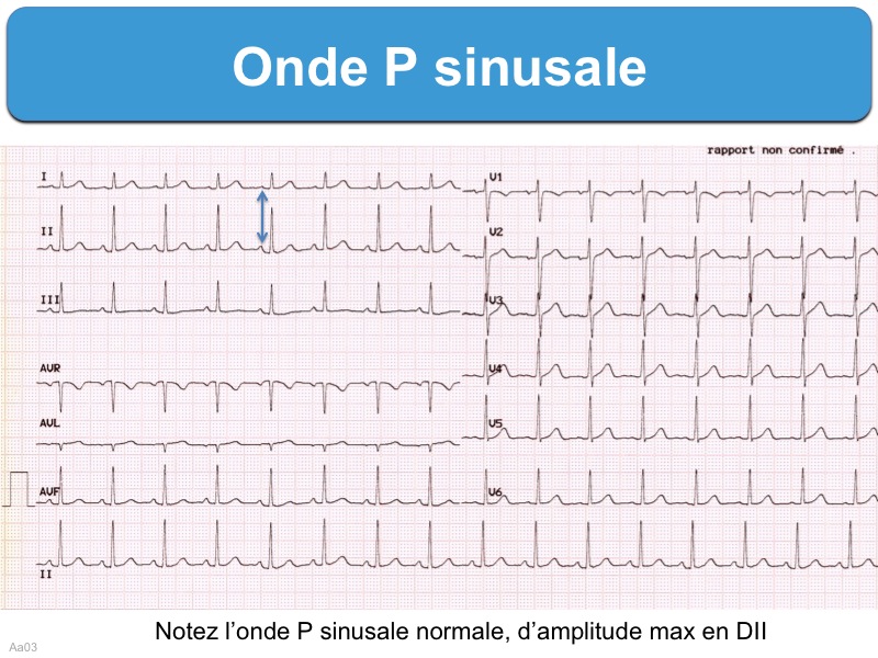 Onde P sinusale : e-cardiogram