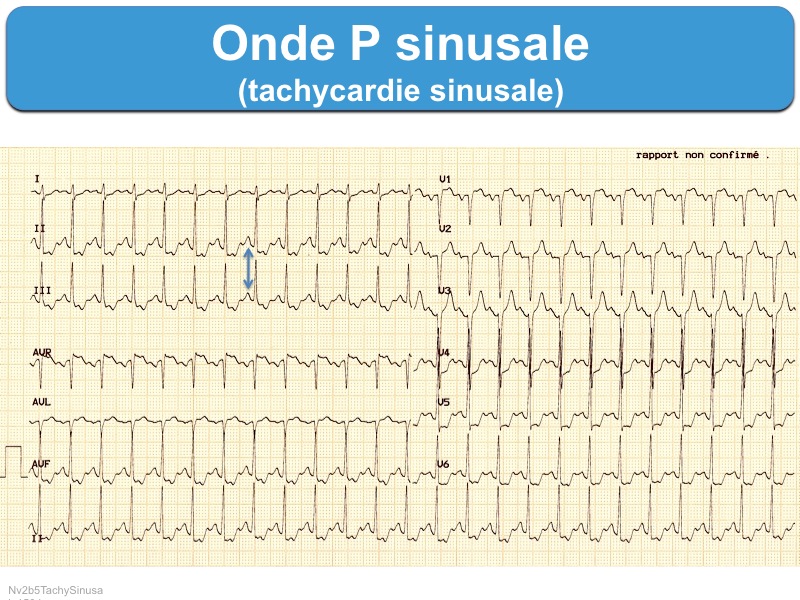 Onde P sinusale : e-cardiogram