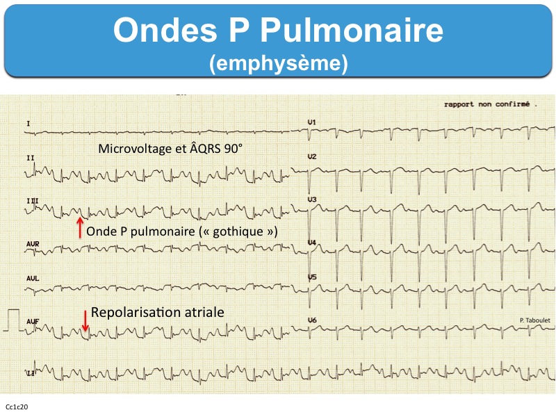 Onde P pulmonaire : e-cardiogram