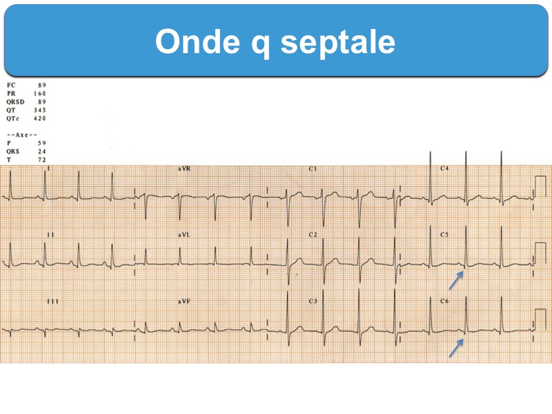 Onde q septale : e-cardiogram