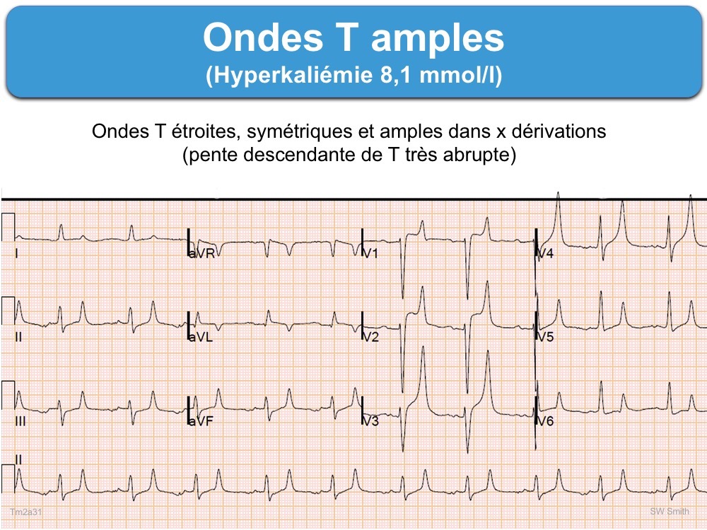 Onde T ample : e-cardiogram