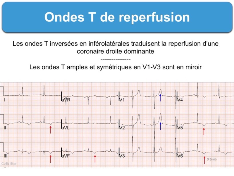 Onde T de reperfusion : e-cardiogram