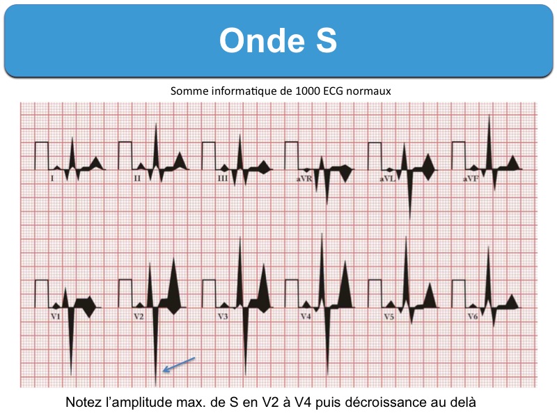 Onde S : e-cardiogram