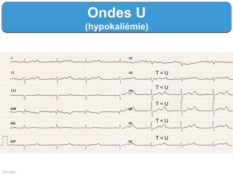 Onde U : e-cardiogram