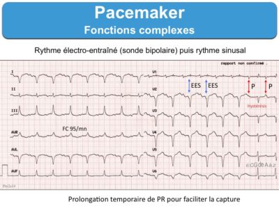 Pacemaker (e) fonctions complexes : e-cardiogram