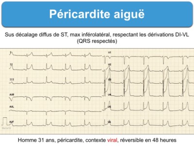 Onde T ample : e-cardiogram