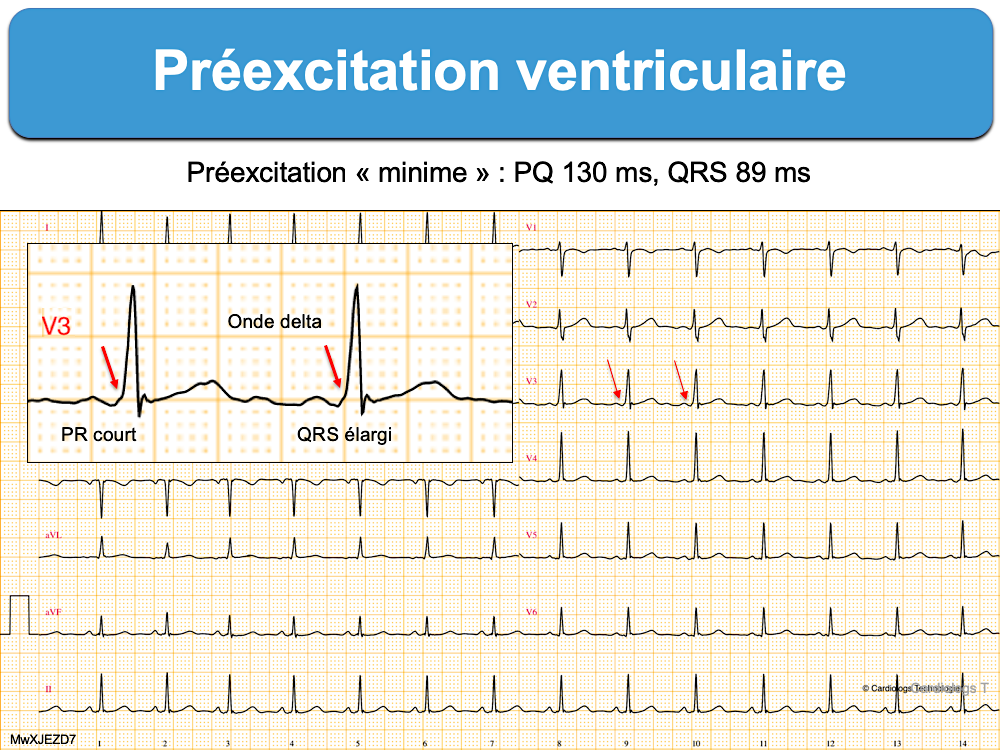 Préexcitation 1. Généralités : e-cardiogram