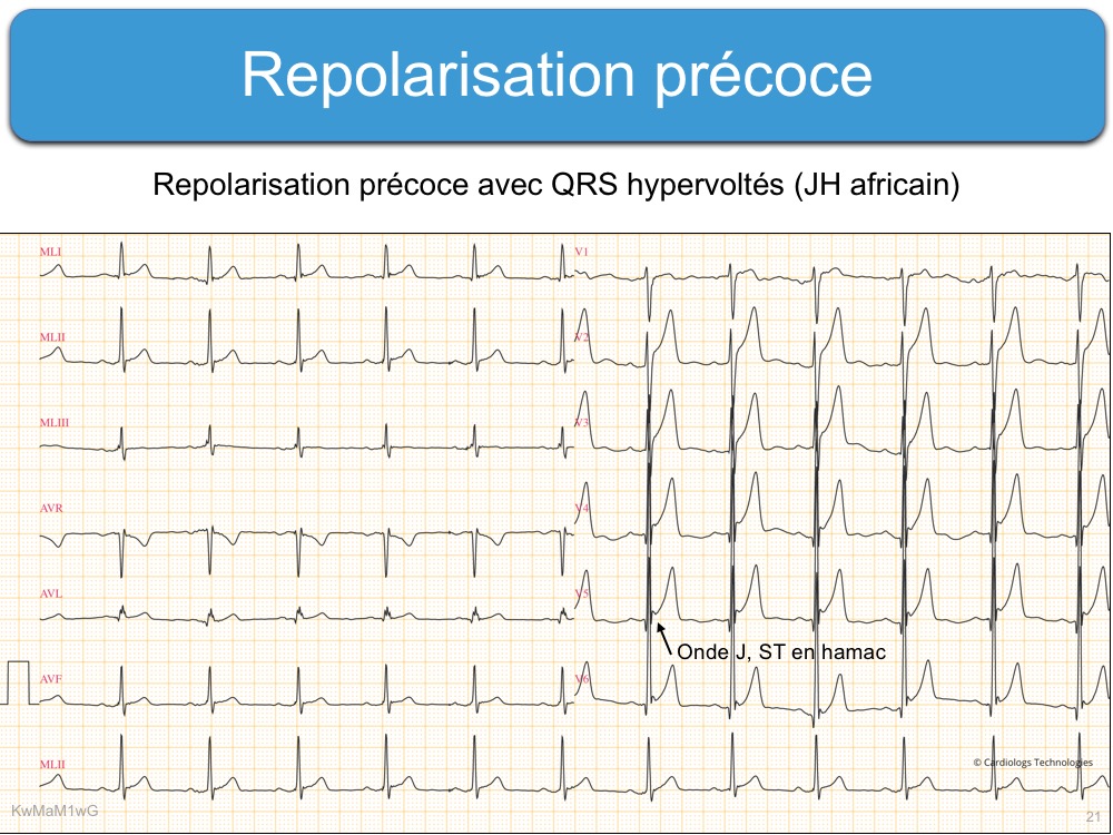 Repolarisation précoce : francais : e-cardiogram