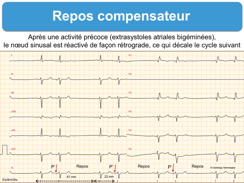 Repos compensateur : e-cardiogram