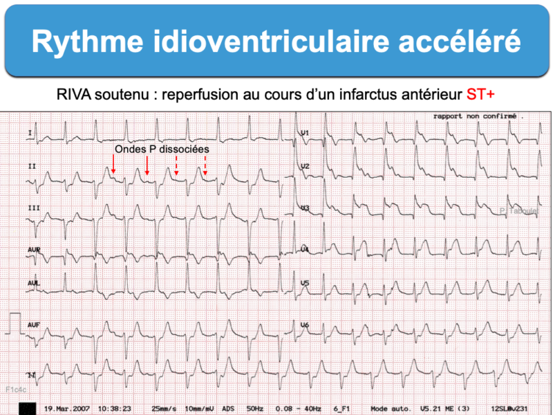 Reperfusion coronaire/TIMI : e-cardiogram