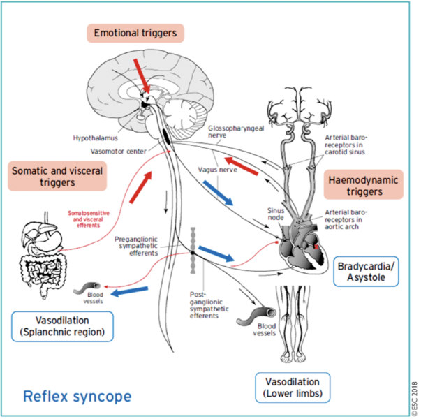 Syncope réflexe : e-cardiogram