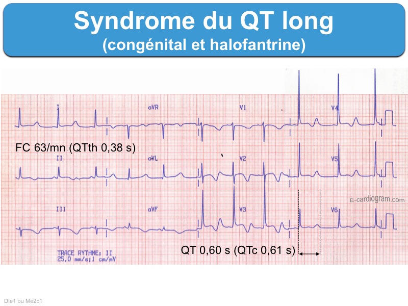 Intervalle QT. 4a. Long : e-cardiogram