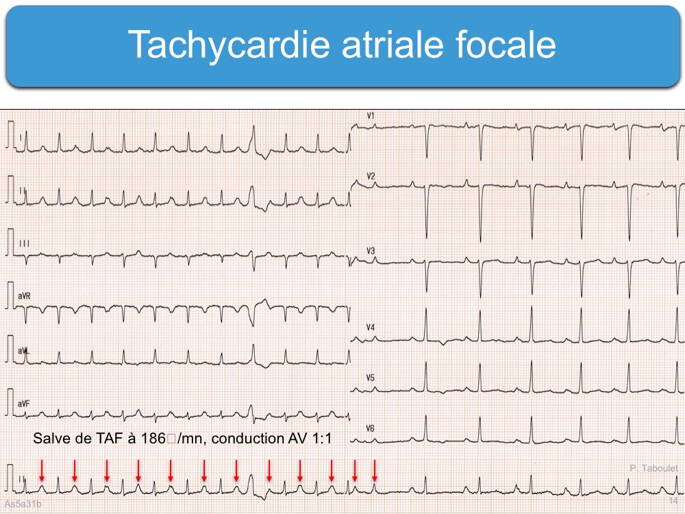 Tachycardie atriale focale : e-cardiogram