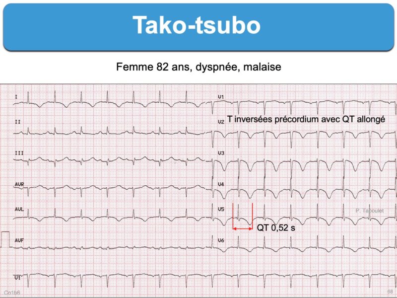 Onde T inversée : e-cardiogram