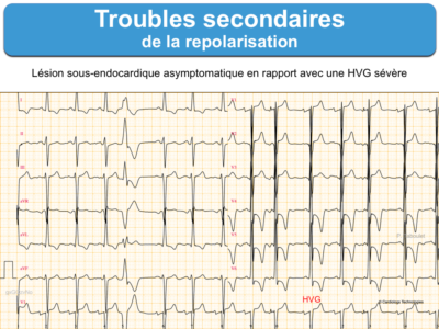 Troubles secondaires de repolarisation : e-cardiogram