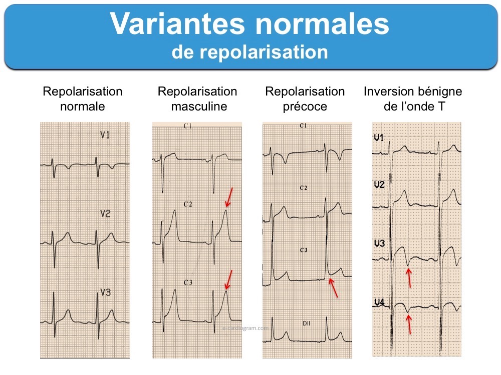 Trouble De Repolarisation Ecg: Troubles De Repolarisation Cardiaque – KOSE