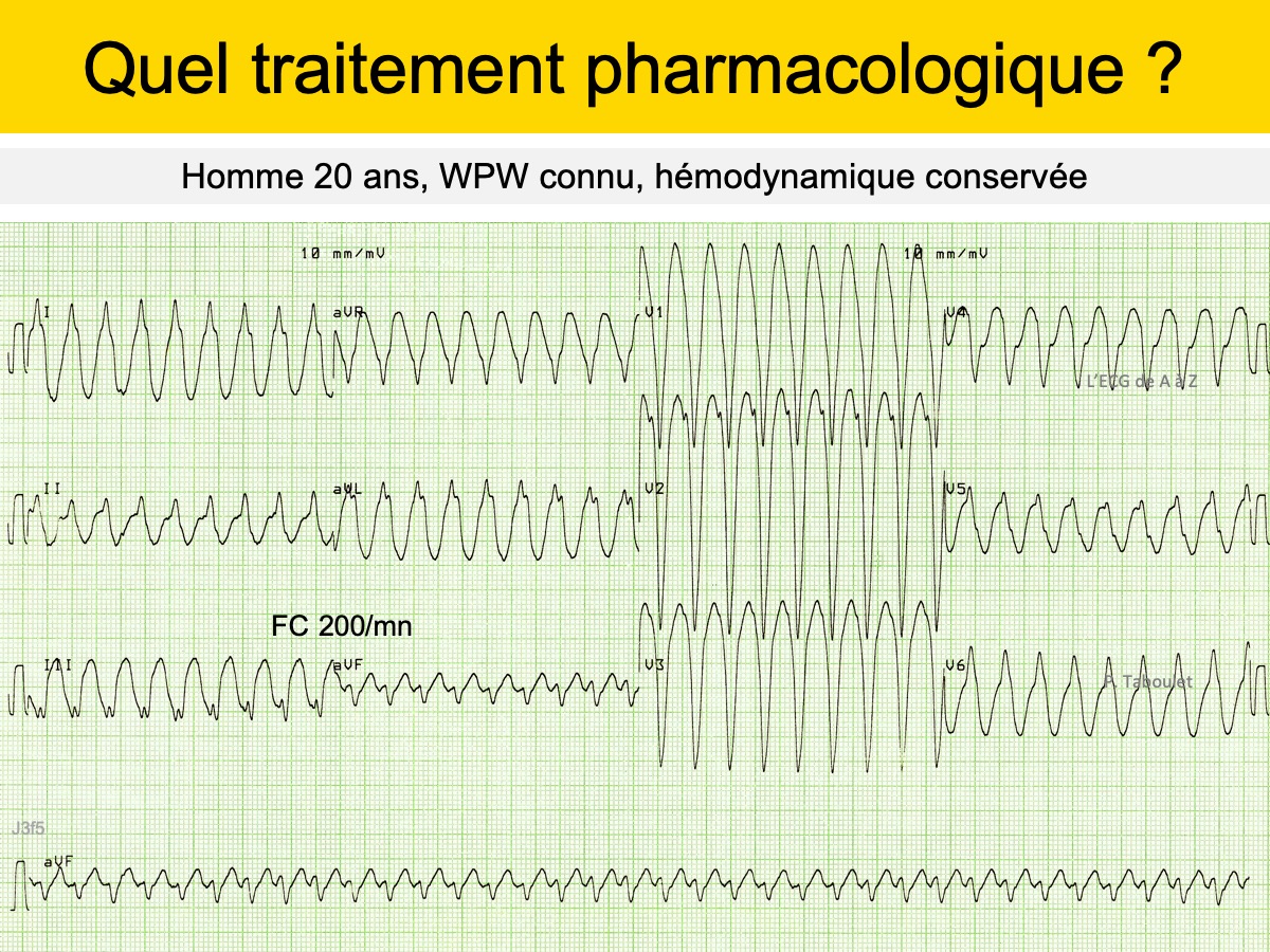 Quiz : Page 74 sur 111 : e-cardiogram