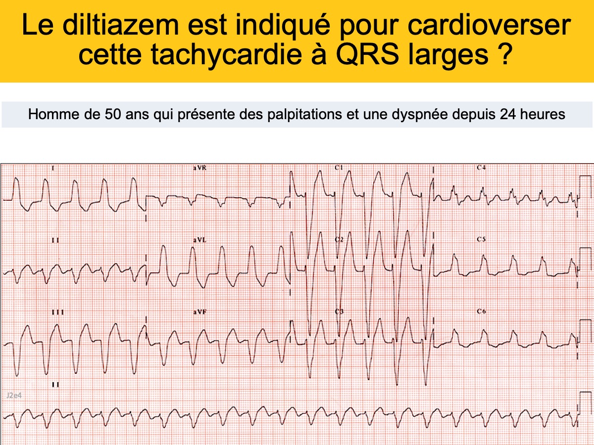 ECG. 4 lecture et analyse : e-cardiogram