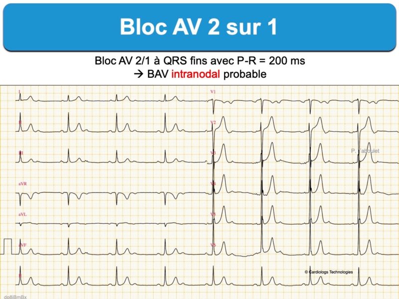 Bloc AV 2e degré. Bloc 2/1 : e-cardiogram