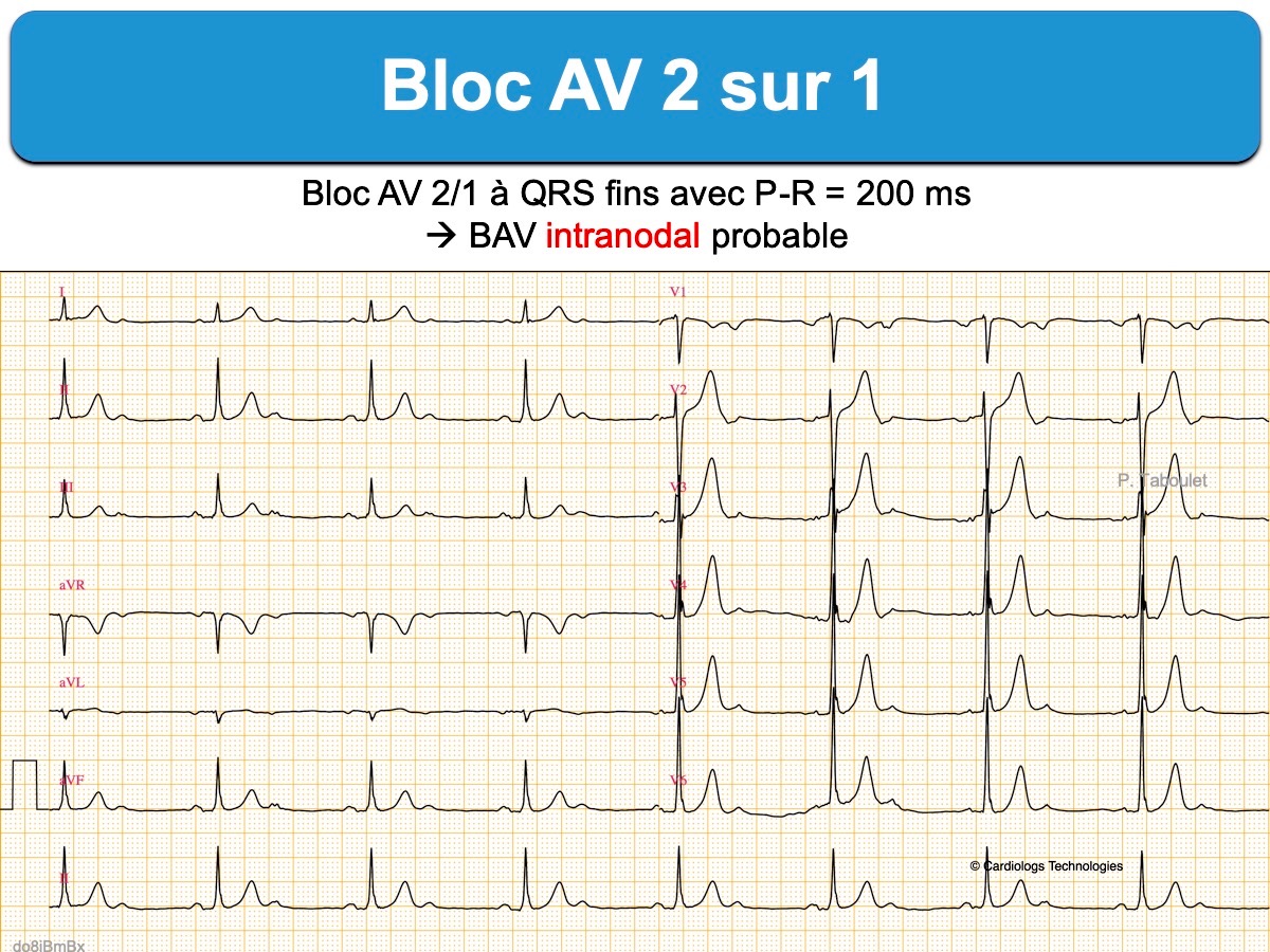 Bloc AV 2e degré. Bloc 2/1 : e-cardiogram