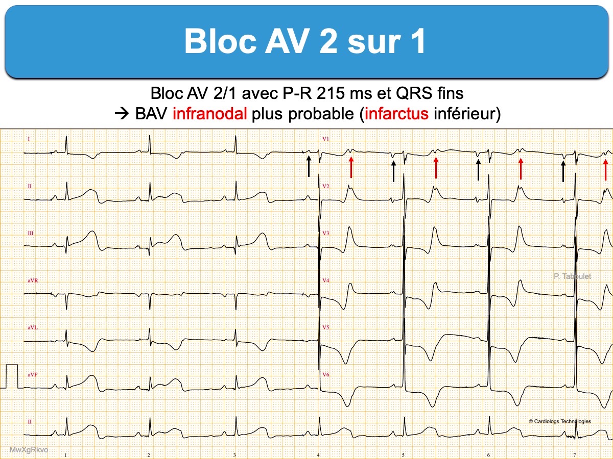 Bloc AV 2e degré. Bloc 2/1 : e-cardiogram