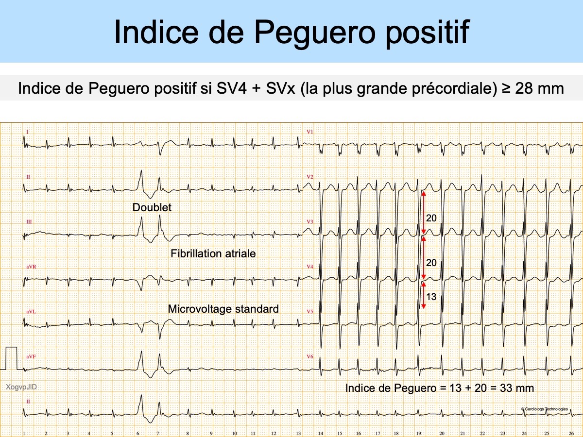 Onde S : e-cardiogram