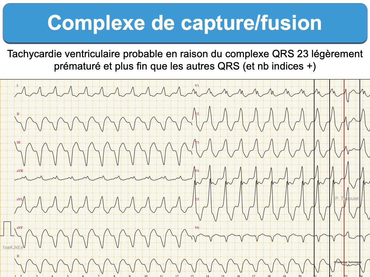 Lexique C : e-cardiogram