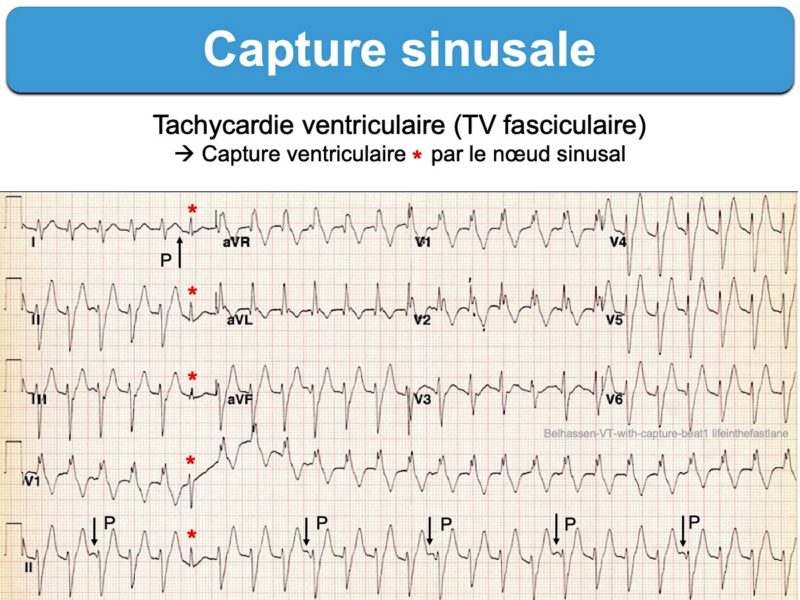 Capture sinusale : e-cardiogram