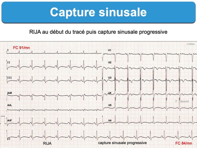 Capture sinusale : e-cardiogram