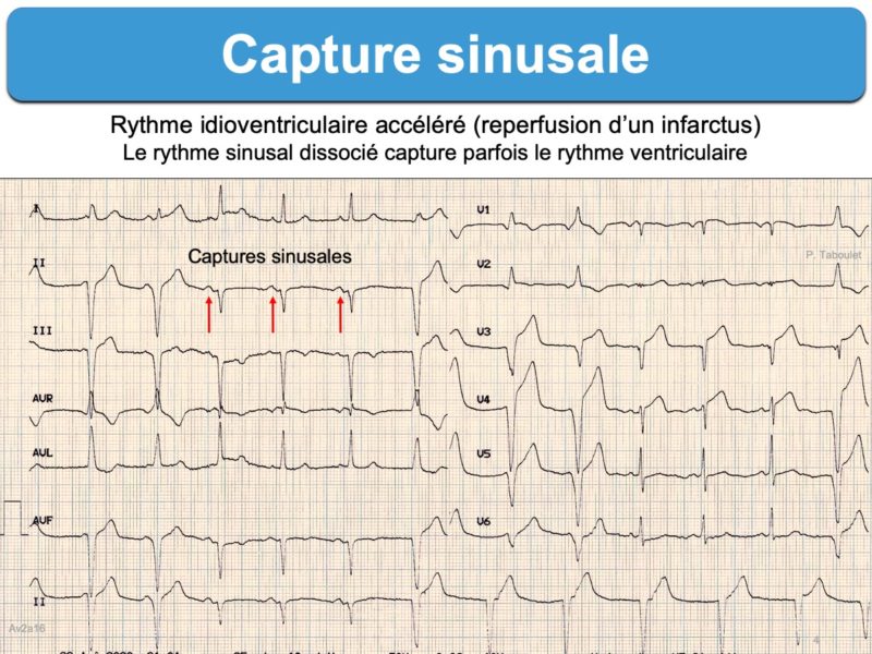 Capture sinusale : e-cardiogram