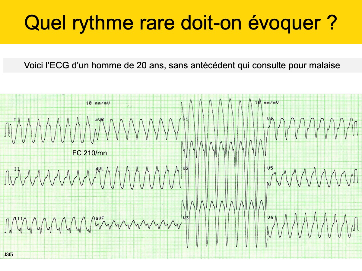 Onde Q : e-cardiogram