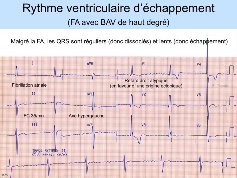 Fibres de Purkinje : e-cardiogram