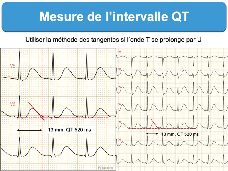 Intervalle QT. 1. Mesure : e-cardiogram