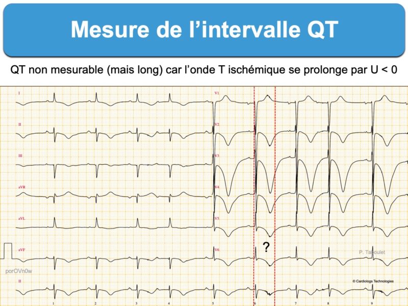 Intervalle QT. 1. Mesure : e-cardiogram