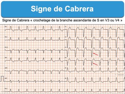 Signe de Cabrera : e-cardiogram