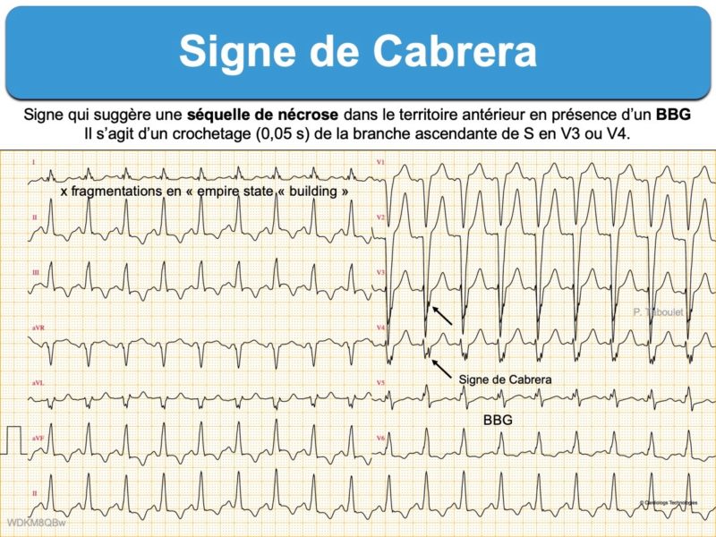 Signe de Cabrera : e-cardiogram