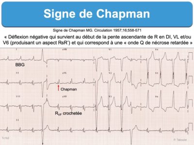 Signe de Chapman : e-cardiogram
