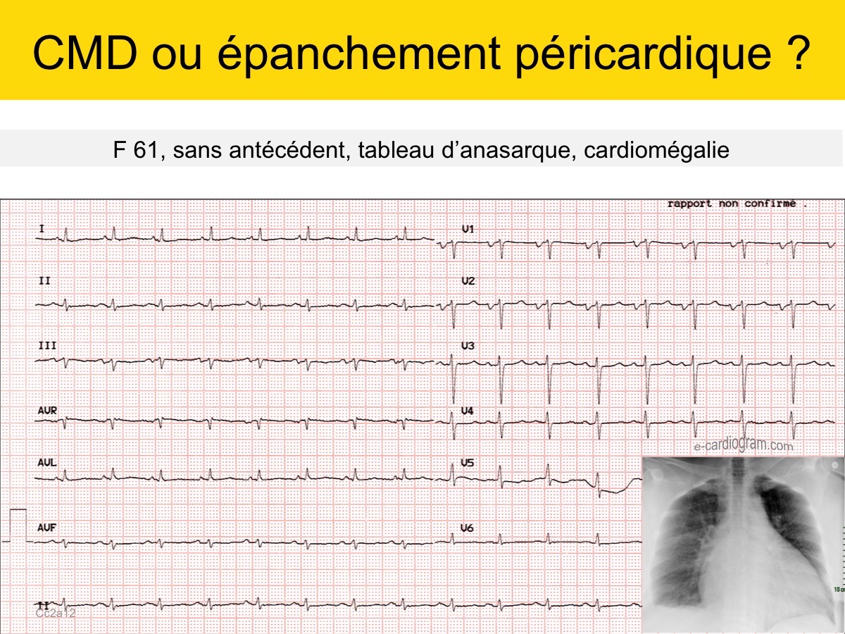 Capture sinusale : e-cardiogram