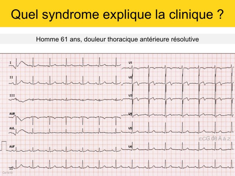 Extrasystole atriale : e-cardiogram