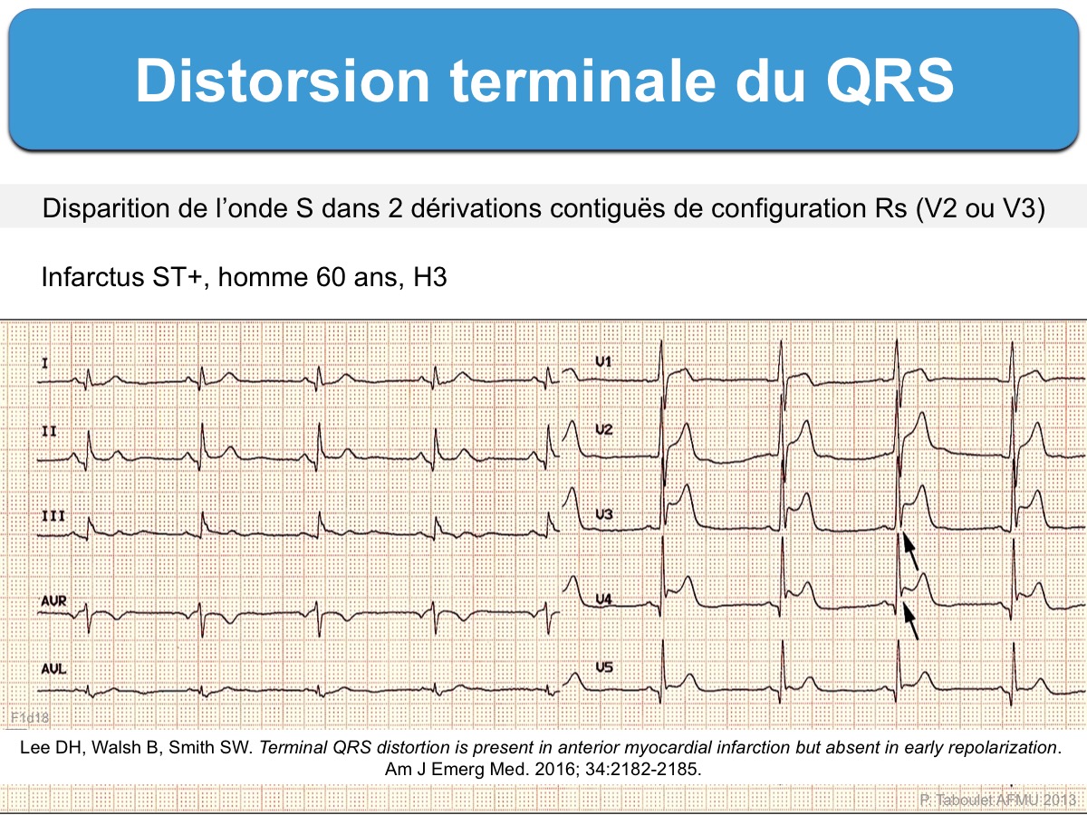 Distorsion terminale du QRS : e-cardiogram