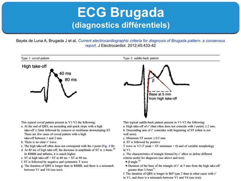Syndrome de Brugada 3. Dg. différentiels : e-cardiogram