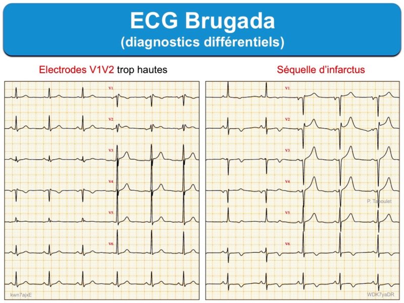 ECG Brugada : diagnostics différentiels : e-cardiogram