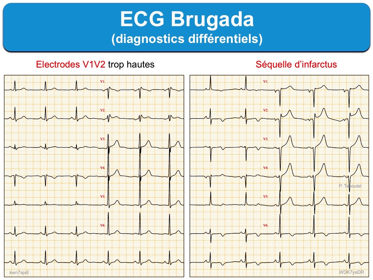 ECG Brugada : diagnostics différentiels : e-cardiogram