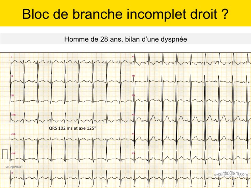 Hypocalcémie : e-cardiogram
