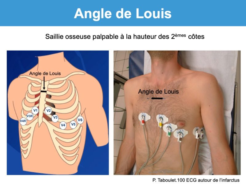 Angle de Louis : e-cardiogram